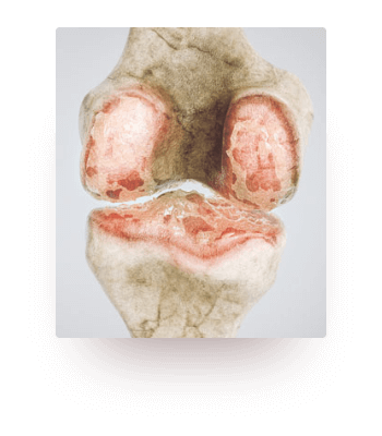 stages-of-ra-2-4 – Good Health We Care
