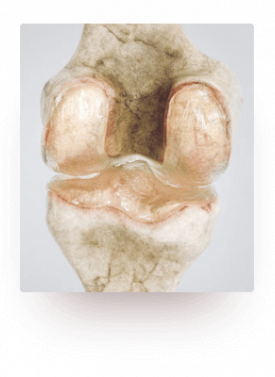 Stages of Rheumatoid Arthritis – Good Health We Care